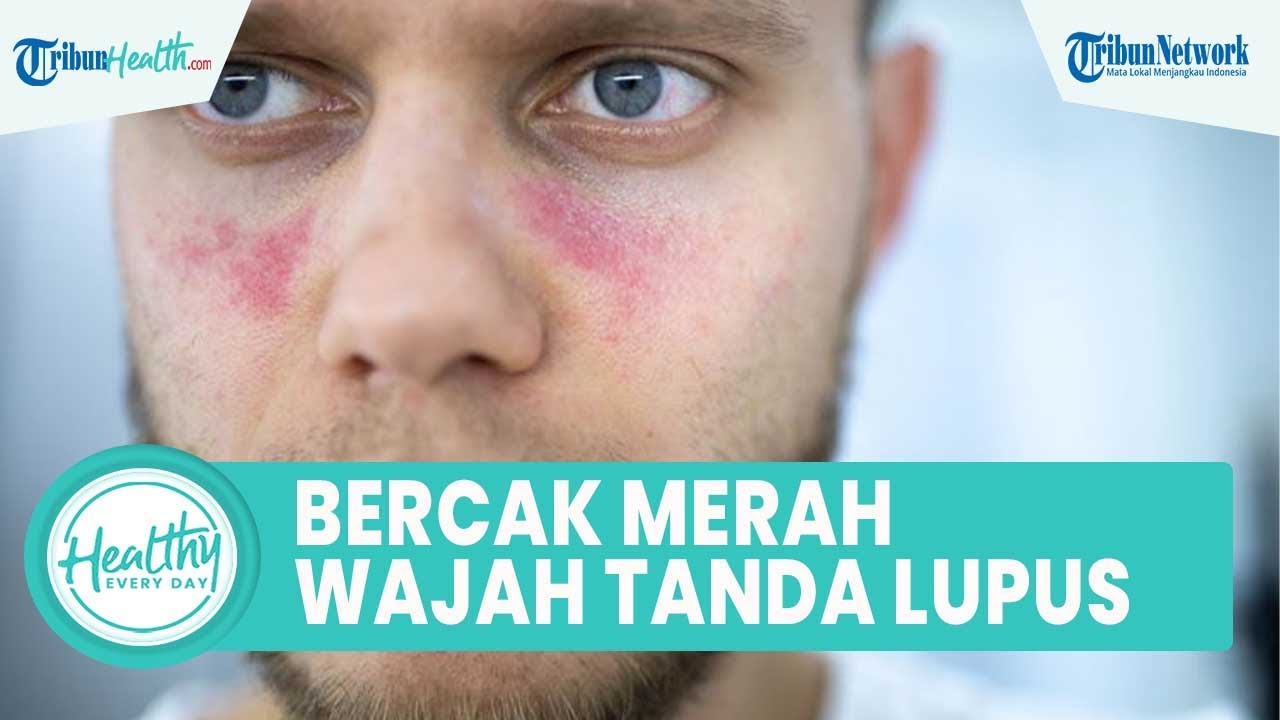 Waspadai Bercak Merah di Wajah Bisa Jadi Gejala Penyakit Lupus, Inilah ...