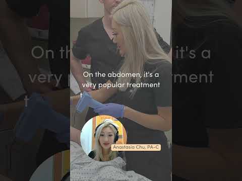 What does Morpheus8 RF microneedling do?