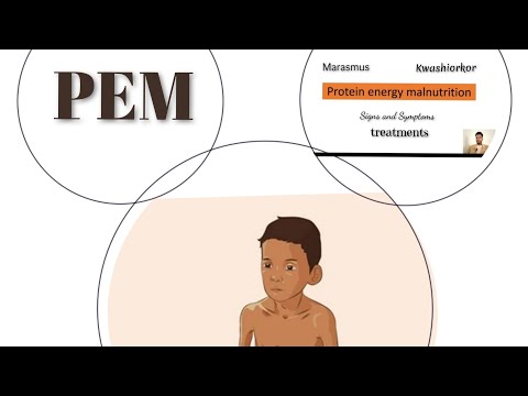 Protein Energy Malnutrition (PEM): Marasmus, Kwashiorkor, Mixed: Causes, signs, Diagnosis, Treatment