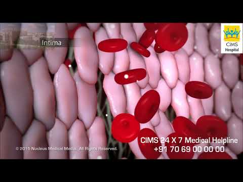 Aortic Aneurysm and Dissection | Dr Dhaval Naik | Cardiac