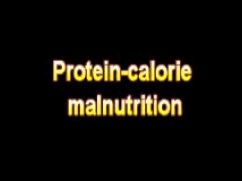 What Is The Definition Of Protein calorie malnutrition Medical School Terminology Dictionary