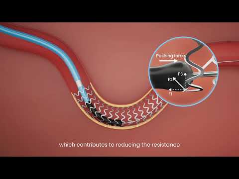CONQUEROR™ Lollipop - NC PTCA balloon catheter