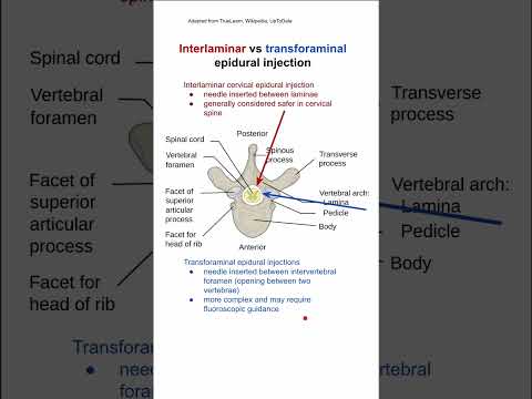 Interlaminar vs transforaminal epidural injection