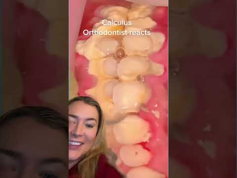 #fyp would you let calculus build up this much? #calculus #teeth #cavities #teethtips