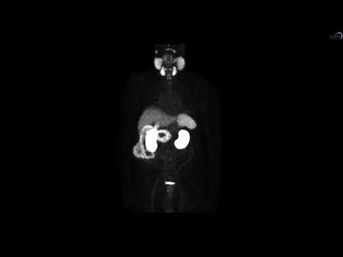 Ga-68 PET/CT Case 1