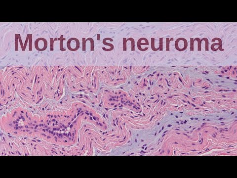 What is a Morton's Neuroma? - Pathology mini tutorial