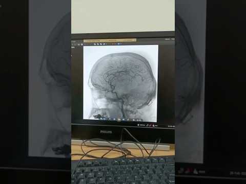 DIGITAL SUBTRACTION ANGIOGRAPHY #(DSA)#shortvideo #viral #ytshorts