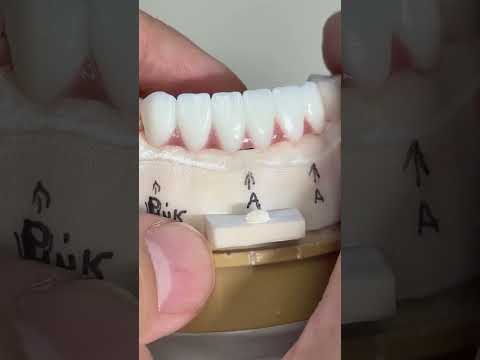 Only 3 implants with 6 units!