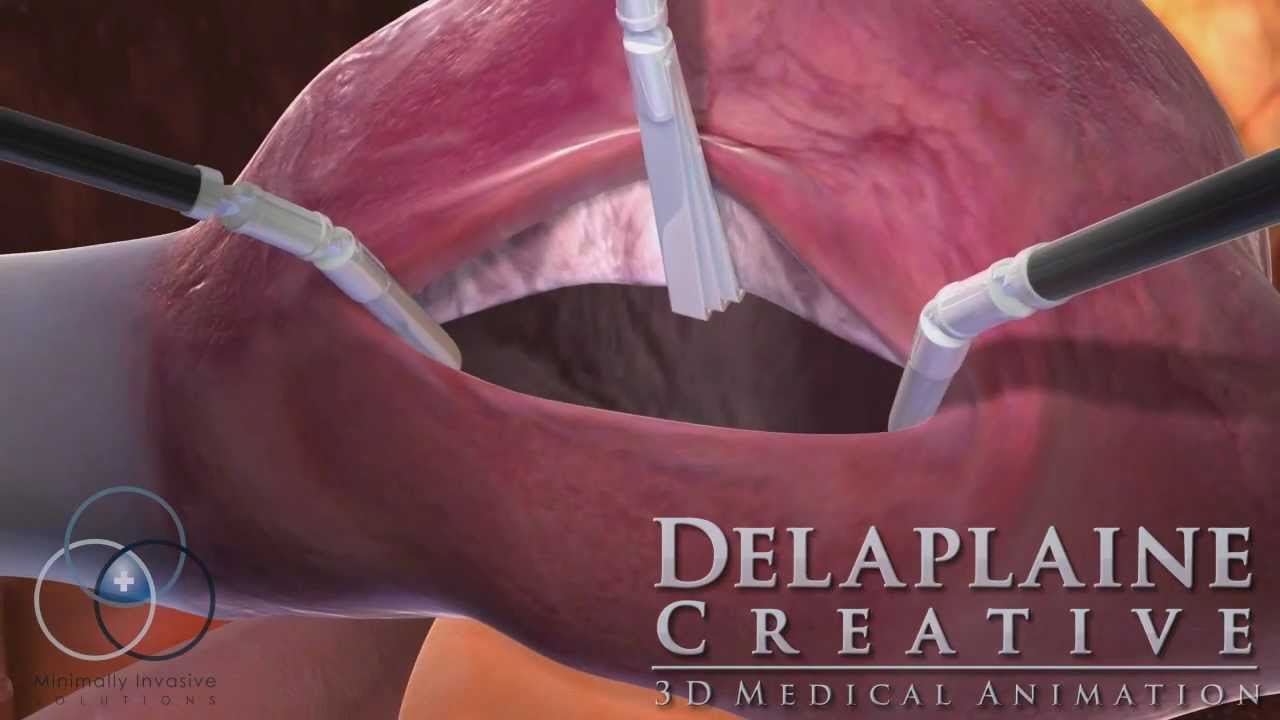 Robotic Atrial Septal Defect Repair