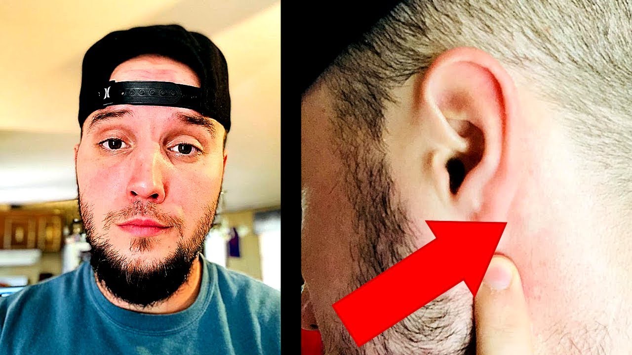 (BIG UPDATE) On The Lump Found Behind My Ear!