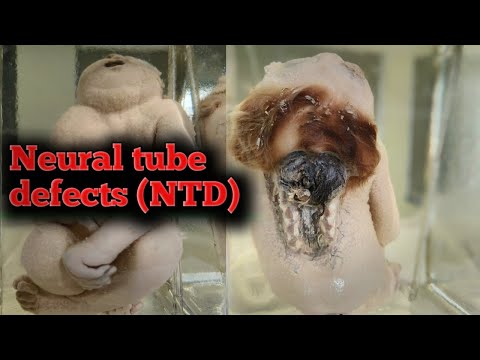 Neural tube defects (NTD)