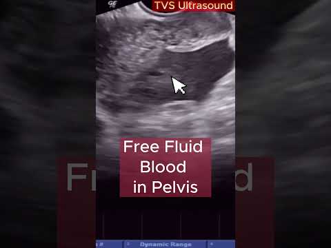 Raptured Ectopic Pregnancy - a Life threatening Emergency #ultrasound #pregnancy