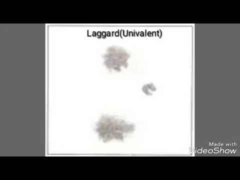 Laggard(Univalent) abnormality-Meiotic Anaphase 1