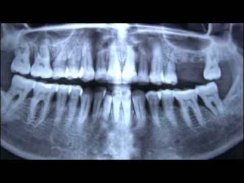 Lynnwood Dental X-rays - Dimayuga Family Dental