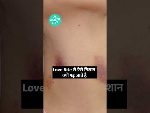Have you ever wondered why hickeys or love bites leave such marks? #shorts | Health Live