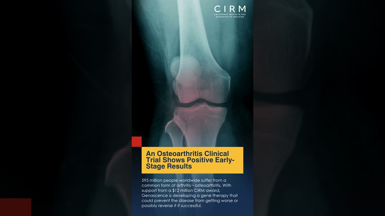 An Osteoarthritis Clinical Trial Shows Positive Early Stage Results #biotech #clinicaltrials