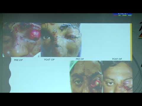 AIOC2020 FP Trauma Dr SAHIL AGRAWAL Traumatic Globe Luxation with Contralateral Quadrantanopia