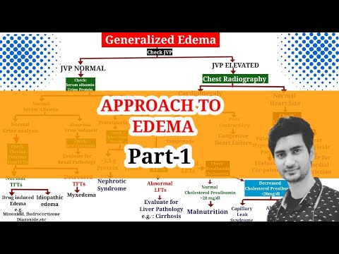 Edema | part-1 | How to Approach | Generalized Edema