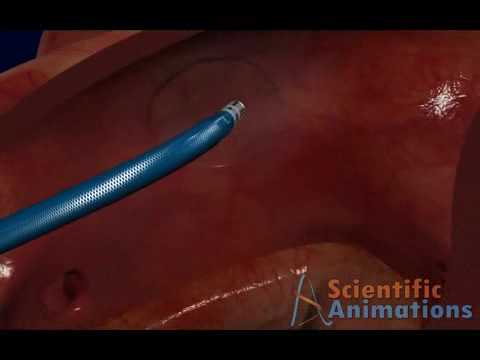 Medical Animation - Robotic catheter system