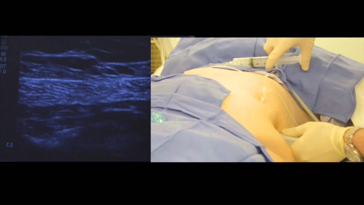 David Leiman -  Rectus Sheath Video