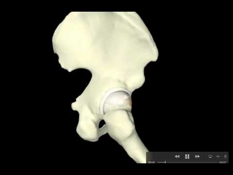Hip Impingement (FAI)- Femoral Cam