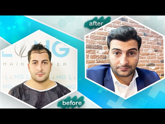 Hair Transplant Turkey | Long Hair Center | Long Hair Center