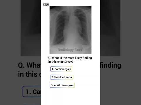 🩻 Radiology Quiz: Can You Identify This Thoracic Finding? 🩻 #radiologybuzz #anatomy
