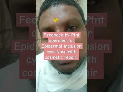Feedback by ptnt operated for Epidermal inclusion cyst Nose