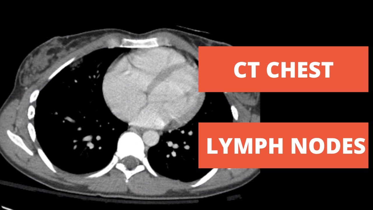 Lymph Nodes Stations of the Chest on CT