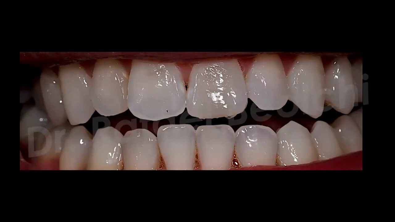Simplified Direct Composite Restorations When and How ?