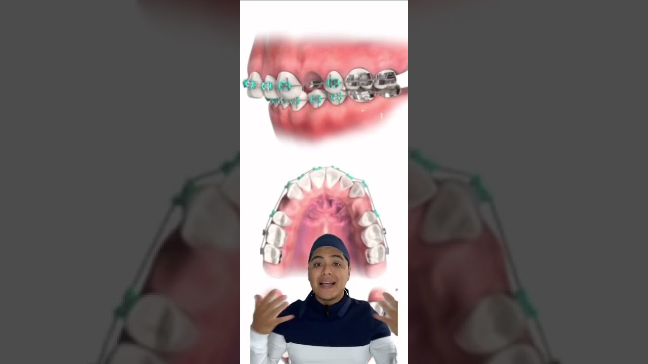 ¿Te SACARÁN MUELAS para ponerte BRACKETS? 😱😏