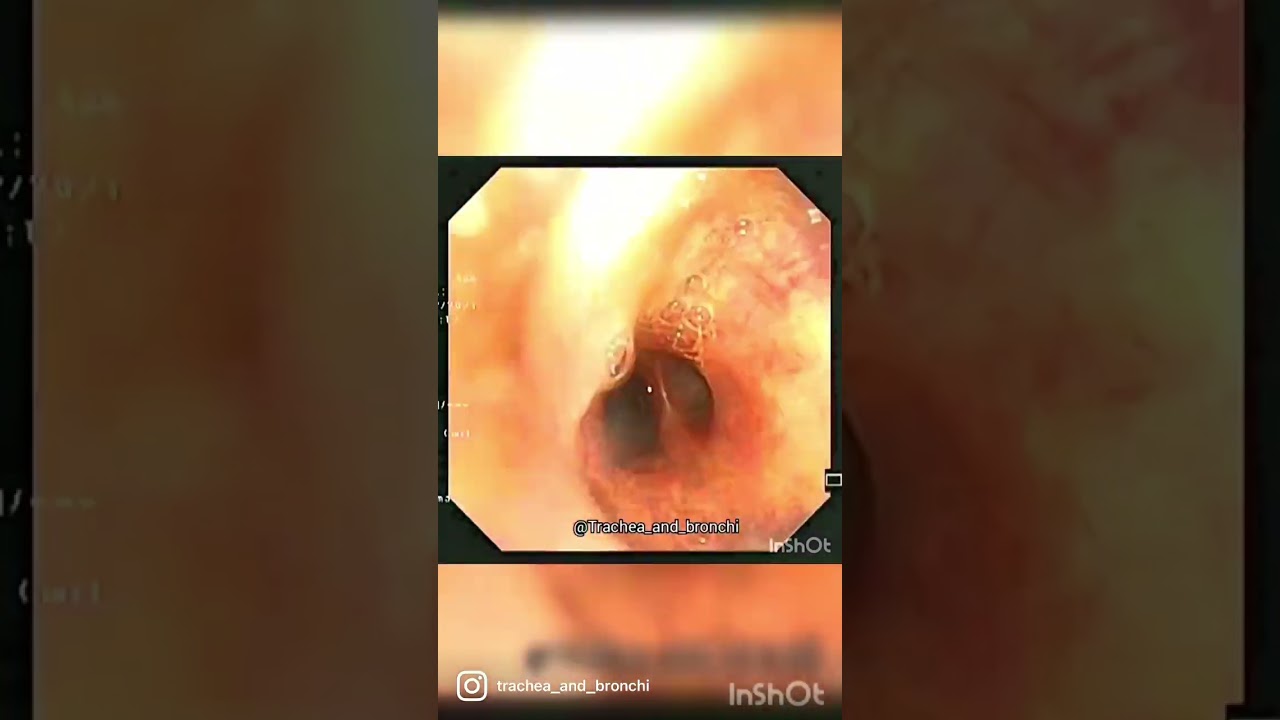 Bronchoscopy Anatomical Orientation Made easy
