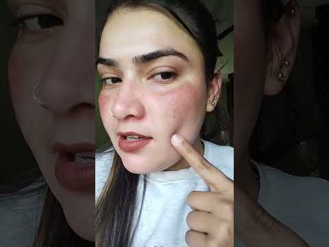 skin shine ne kya face kharab