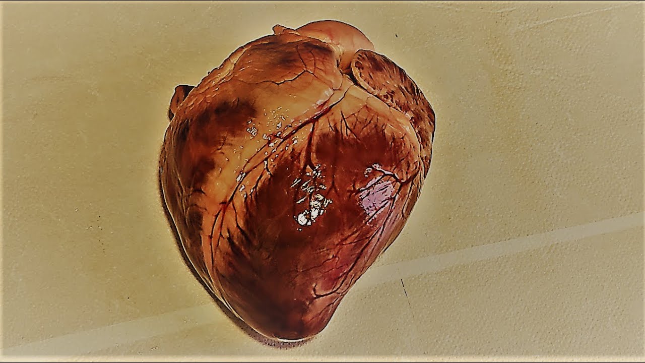 Disección corazón
