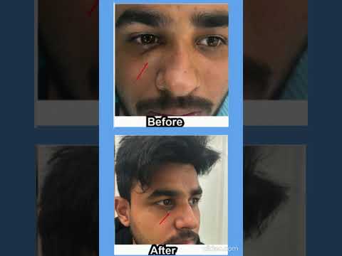 Dr. Ram ENT Hospital: Transforming Lives with Hemangioma Surgery #expertcare #entspecialist #drram