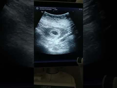 Case of bicornuate uterus with pregnancy