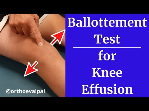 Ballottement Test for Effusion in the Knee