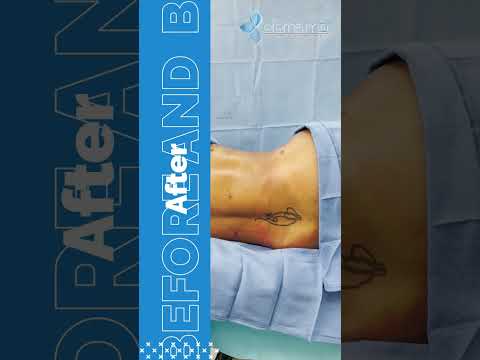 Colombian Liposculpture | Dr. Mercado | Eterna M.D. Medical Rejuvenation Center | Orlando, Florida