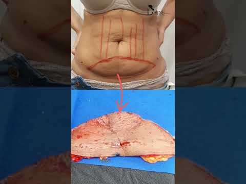 What is Mini Tummy Tuck Surgery | Before and After | Divine Cosmetic Surgery #shorts