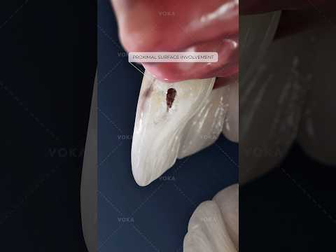 What are Class III carious lesions and how do they impact your oral health? 3D animation