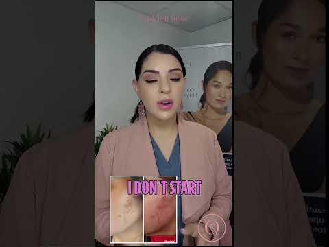 The Ultimate Guide to Spironolactone for Hormonal Acne Treatment Discover the optimal dosage for spi