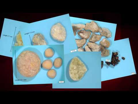 Spotlight on Testing: Laboratory testing for evaluation of renal calculi