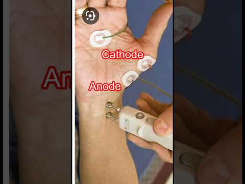 Nerve conduction studies|| Diabetes|| #diabetes #numbness