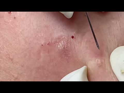 Acne Treatment New 2025 | Blackheads & Whiteheads Removal Mimi channel 020