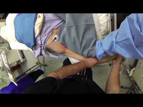 MUA (manipulation under anesthesia) of the Shoulder After Trauma