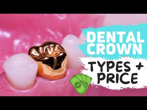 Dental Crowns Explained | WATCH BEFORE YOUR CROWN PROCEDURE!
