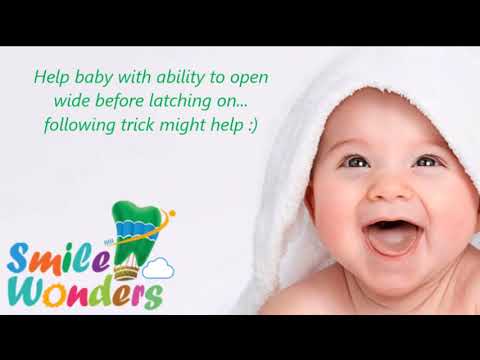 Infant Frenectomy - Aftercare - Part 3 - Suck Training and Habilitation