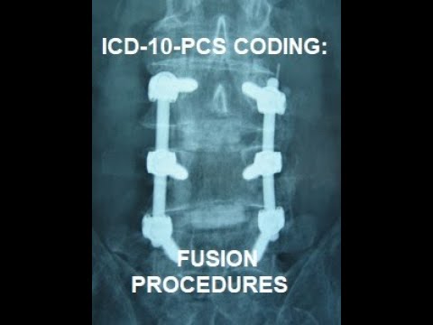 ICD-10-PCS Coding for Fusions