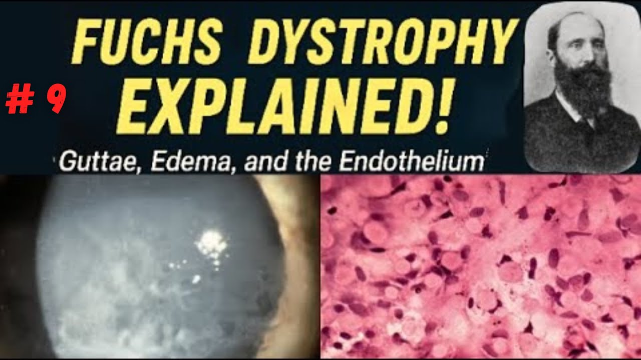 Fuchs’ Dystrophy Simplified: From Guttae to Grafts