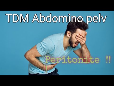 scanner abdomino pelvienne Contracture abdominale diffuse : suspicion de péritonite.
